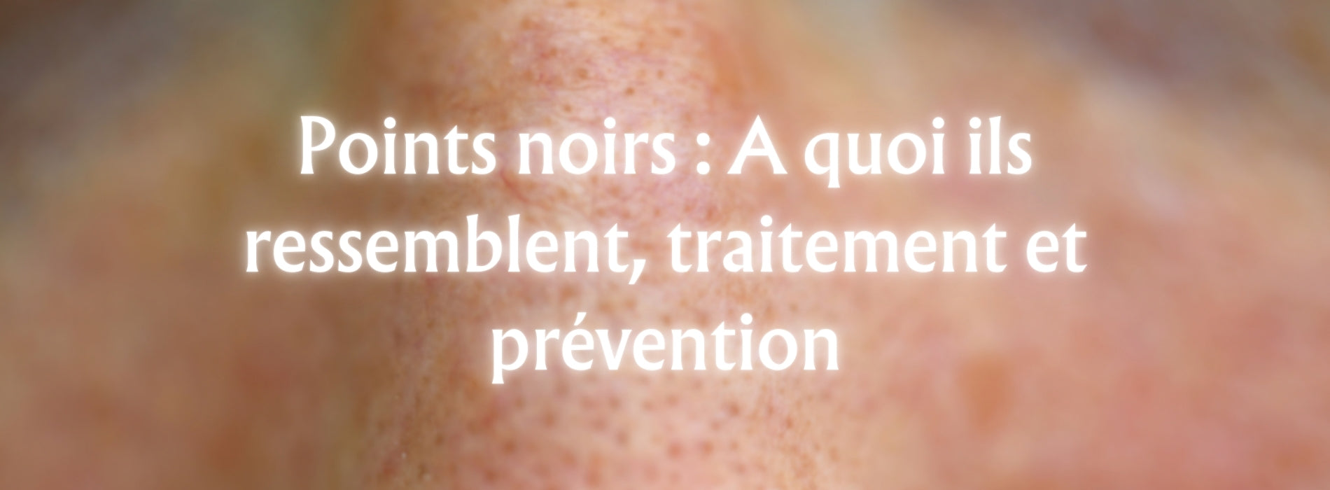 Points noirs : A quoi ils ressemblent, traitement et prévention – Nalovea